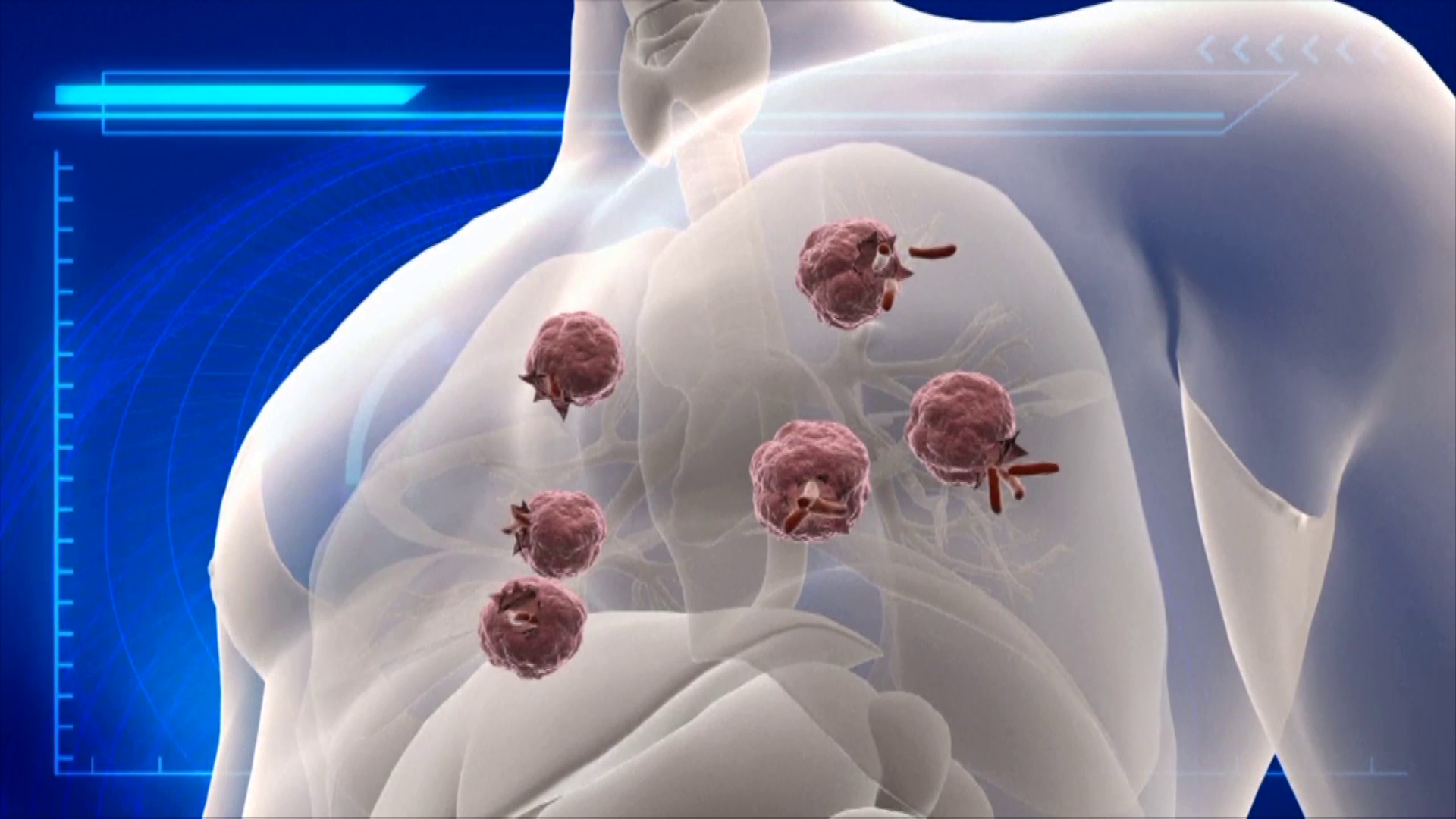 Reportagem explica como identificar e tratar a tuberculose – Notícias ...